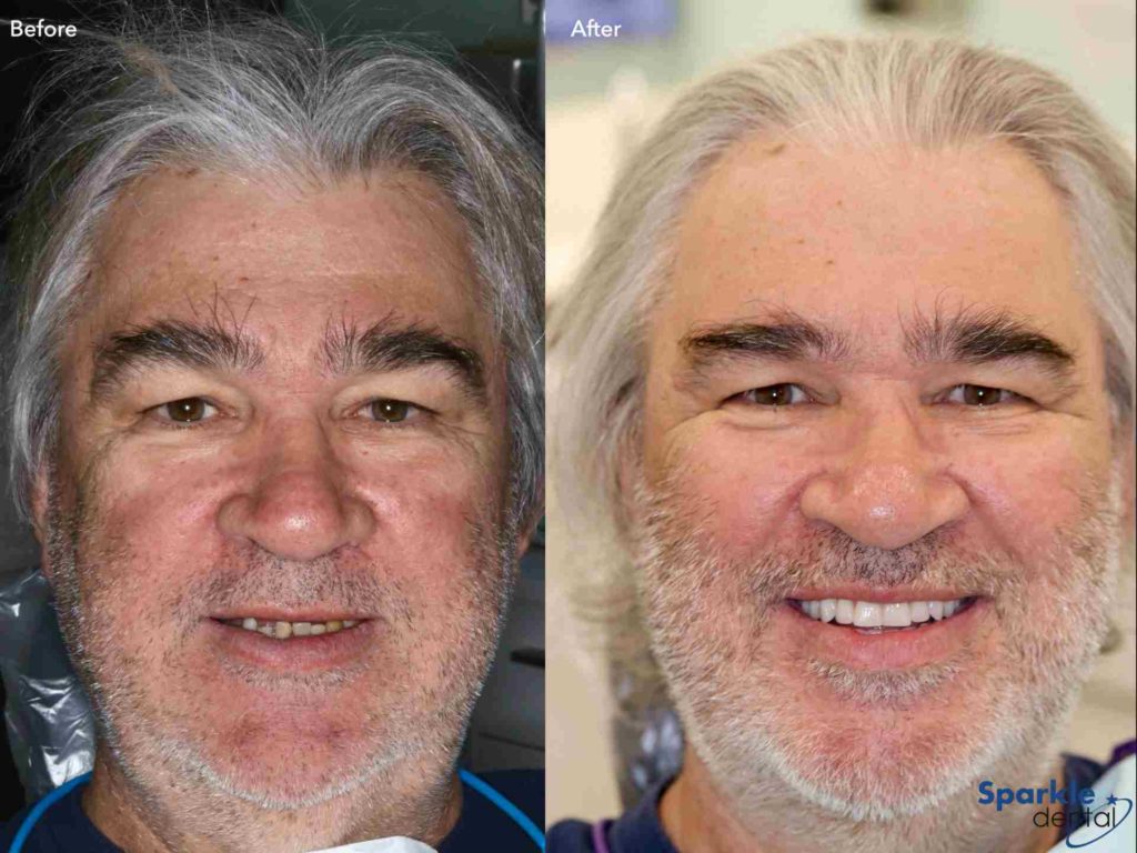 All-on-X Implants | Sparkle Dental